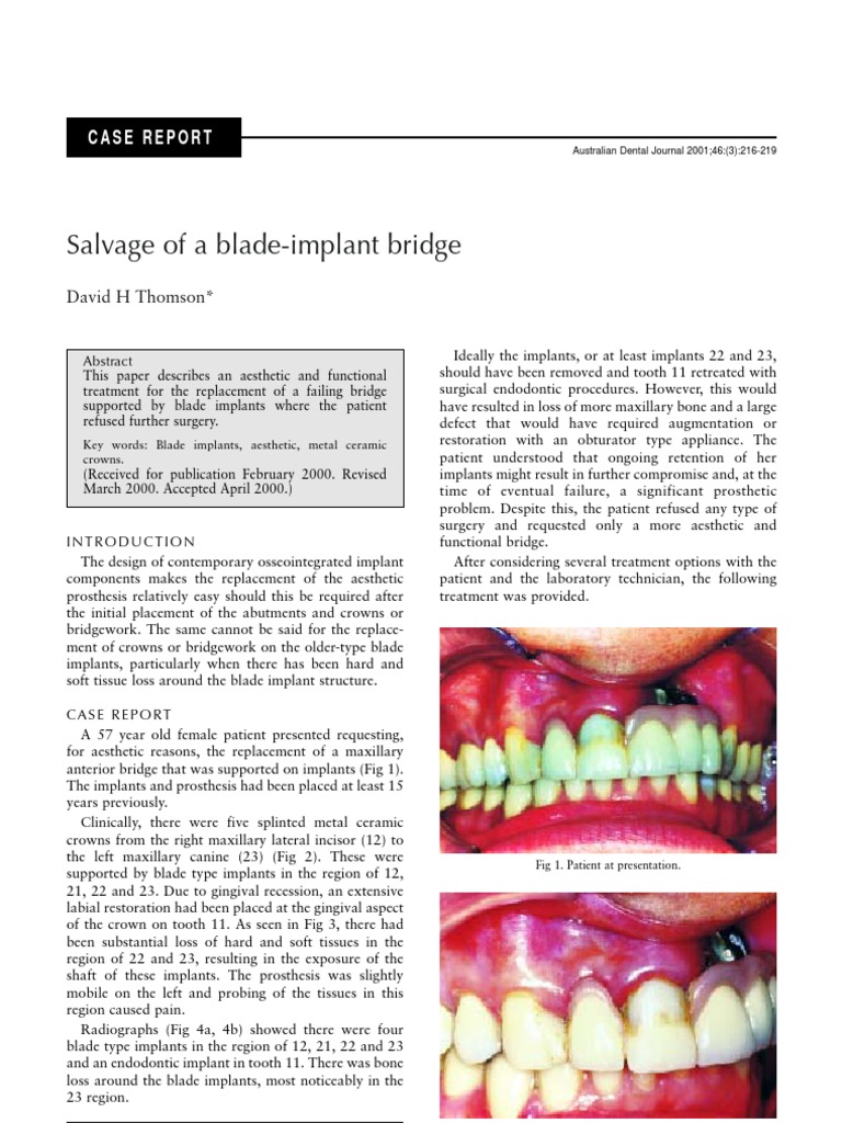 Salvage of A Blade-Implant | PDF | Dental Implant | Mouth