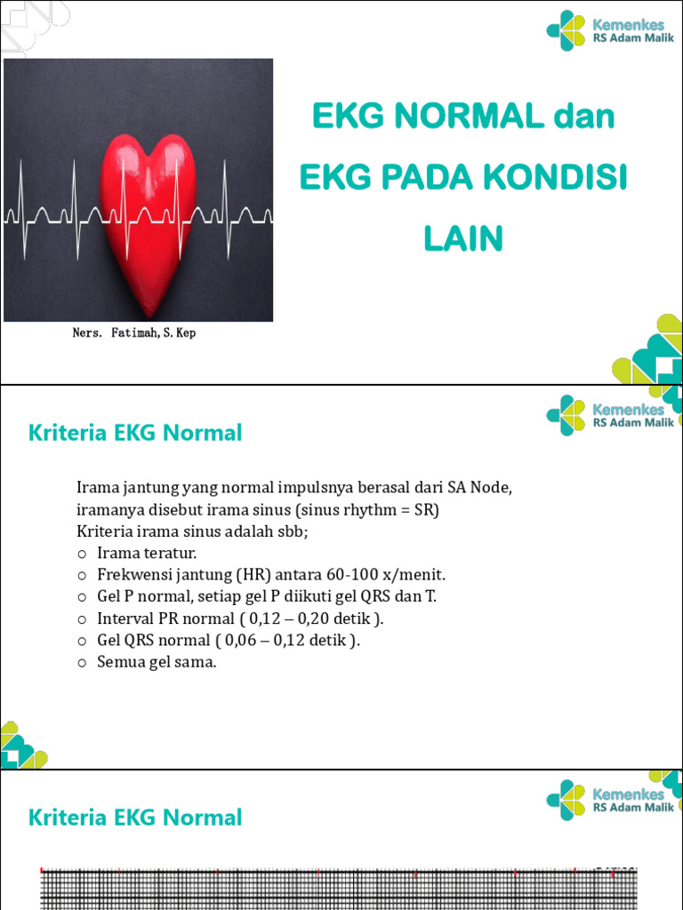 Kriteria EKG Normal dan Aritmia | PDF