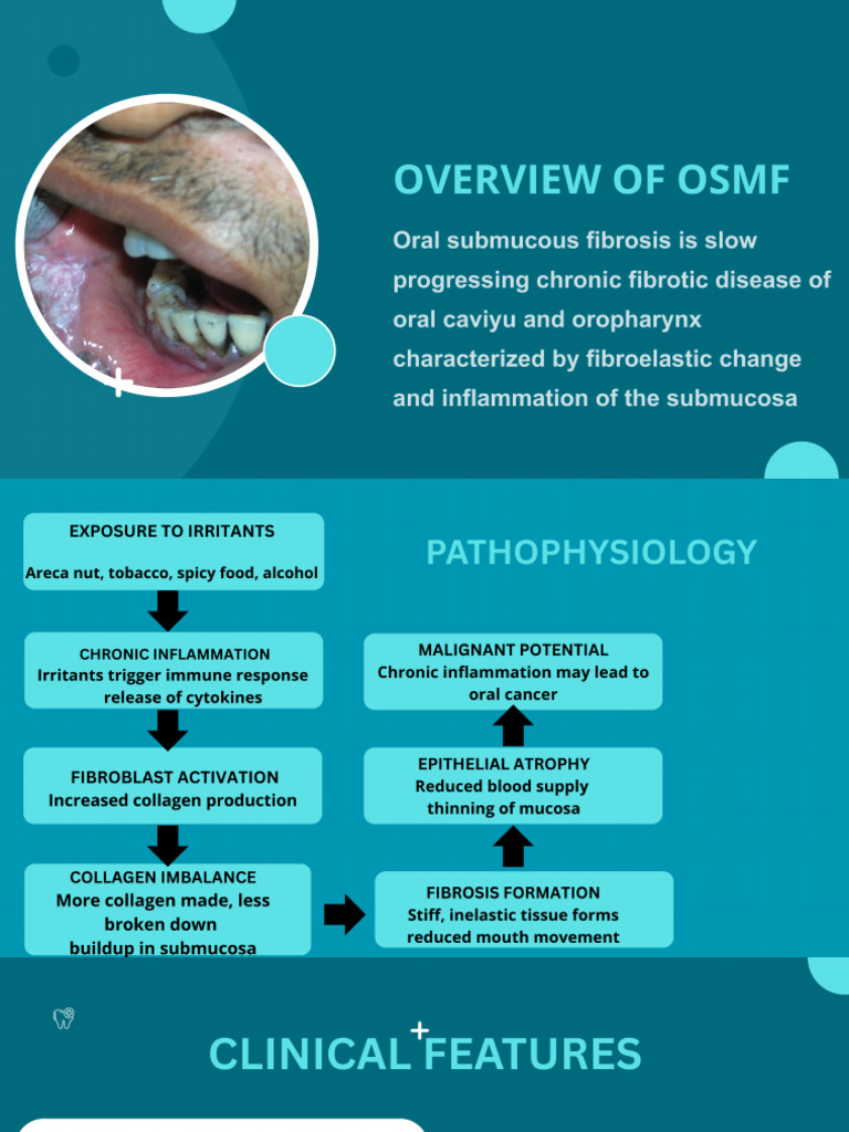 Conservative Management of OSMF (Without First Slide) | PDF
