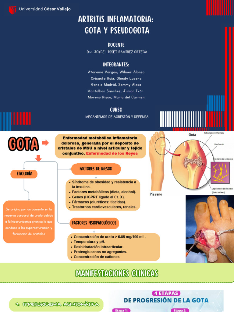 Artritis Inflamatoria: Gota y Pseudogota | PDF | Gota | Articulación