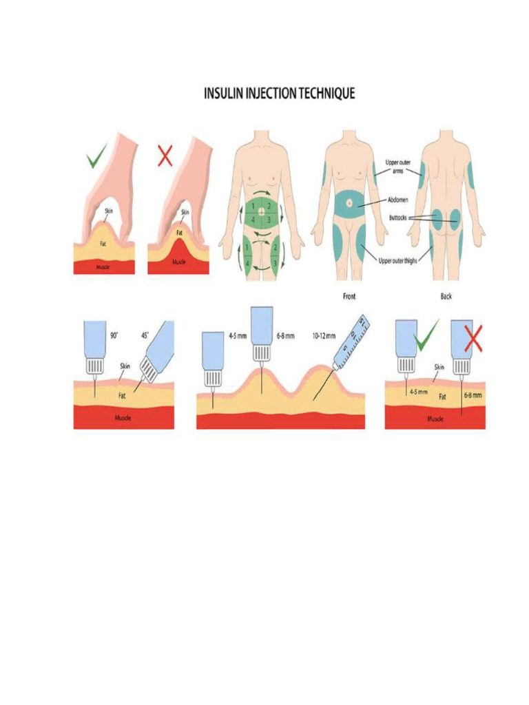 Insulin Injection Sites | PDF