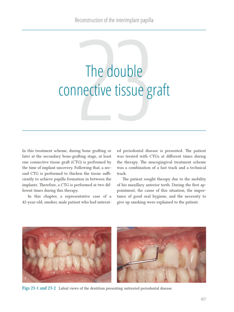 Vertical 2 The Next Level of Hard and Soft Tissue Augmentation (p418 ...