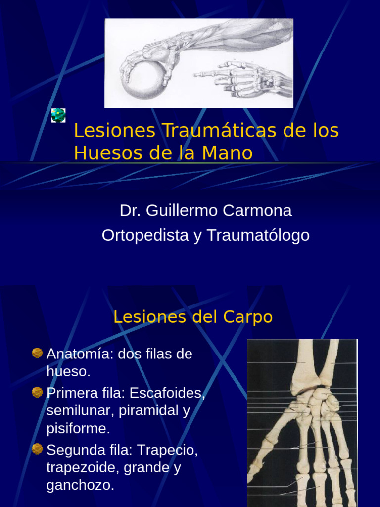 Lesiones Traumáticas de Los Huesos de La Mano | PDF | Mano | Traumatologia