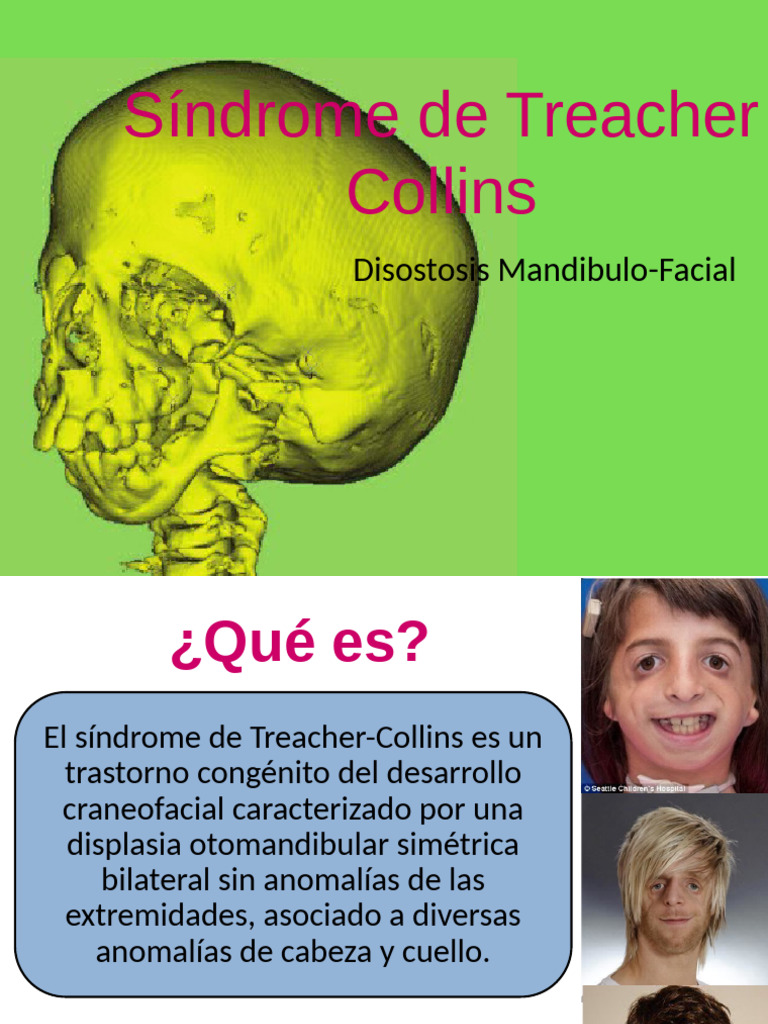 Síndrome de Treacher-Collins: Causas y Tratamiento | PDF ...