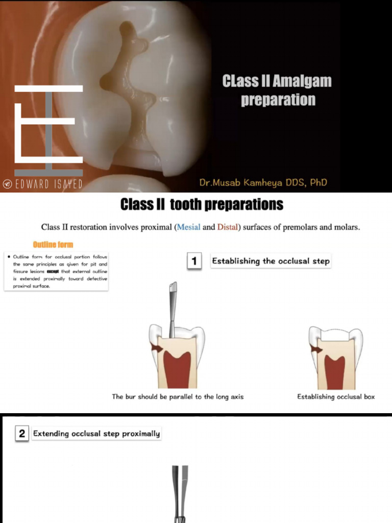 6 Class II Amalgam Preparations | PDF