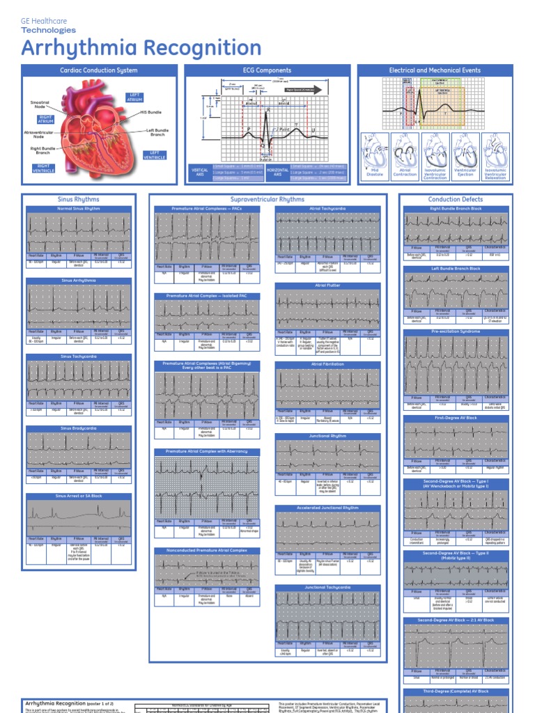 Arrhythmia | PDF | Electrocardiography | Artificial Cardiac Pacemaker