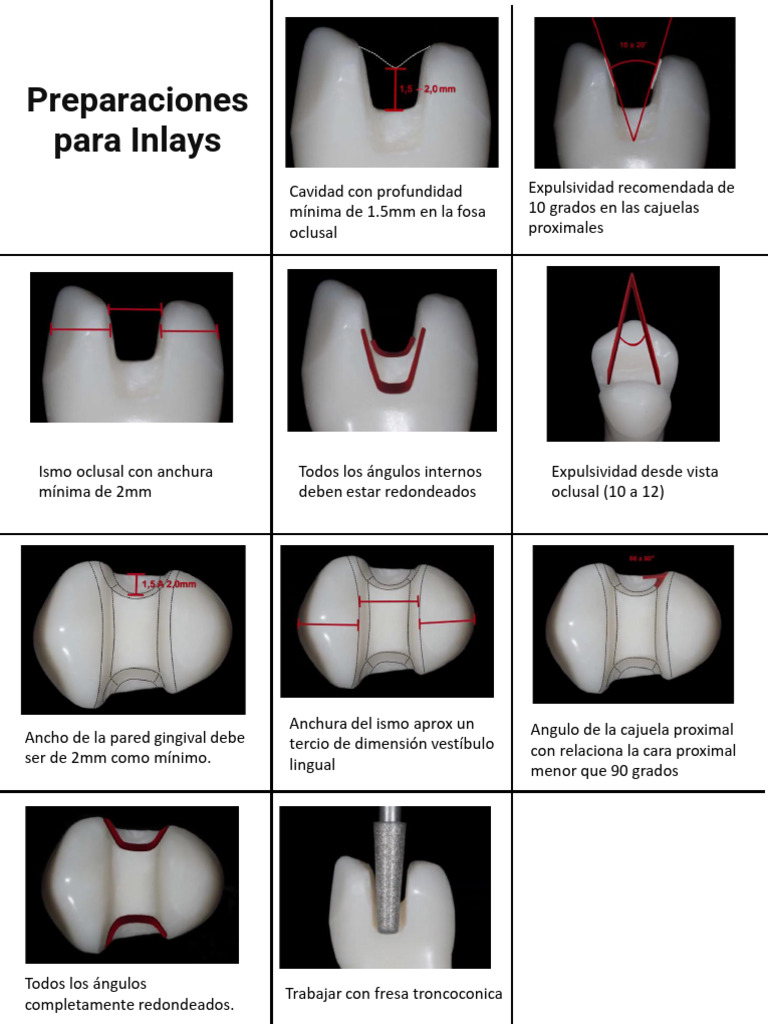 Inlays Onlays | PDF