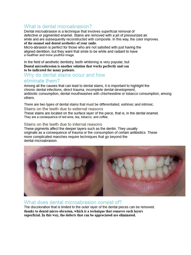 Dental Microabrasion Explained | PDF | Tooth Enamel | Human Tooth