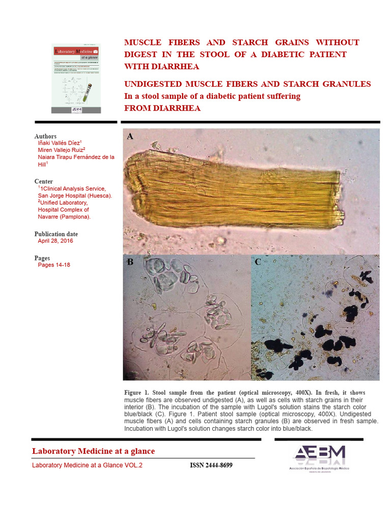 Undigested Muscle Fibers in Diabetic Stool | PDF | Diarrhea | Diabetes