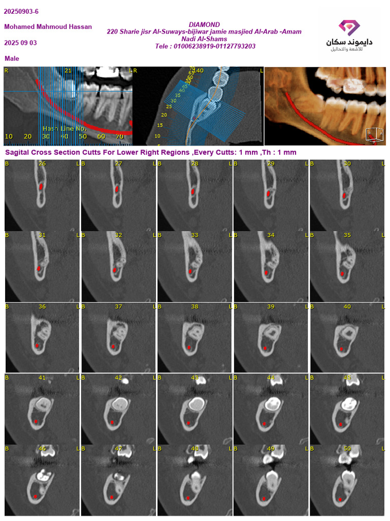 Mandible Axial Cuts and Measurements | PDF