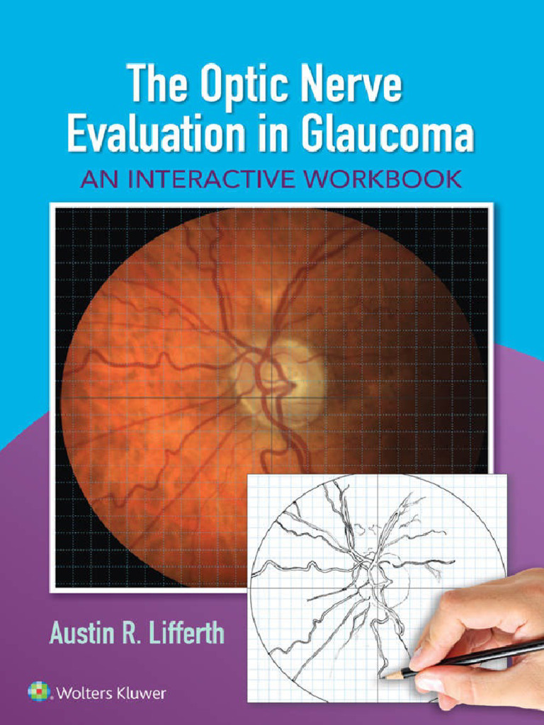 Wedge Defect in Glaucoma Evaluation | PDF | Glaucoma | Eye