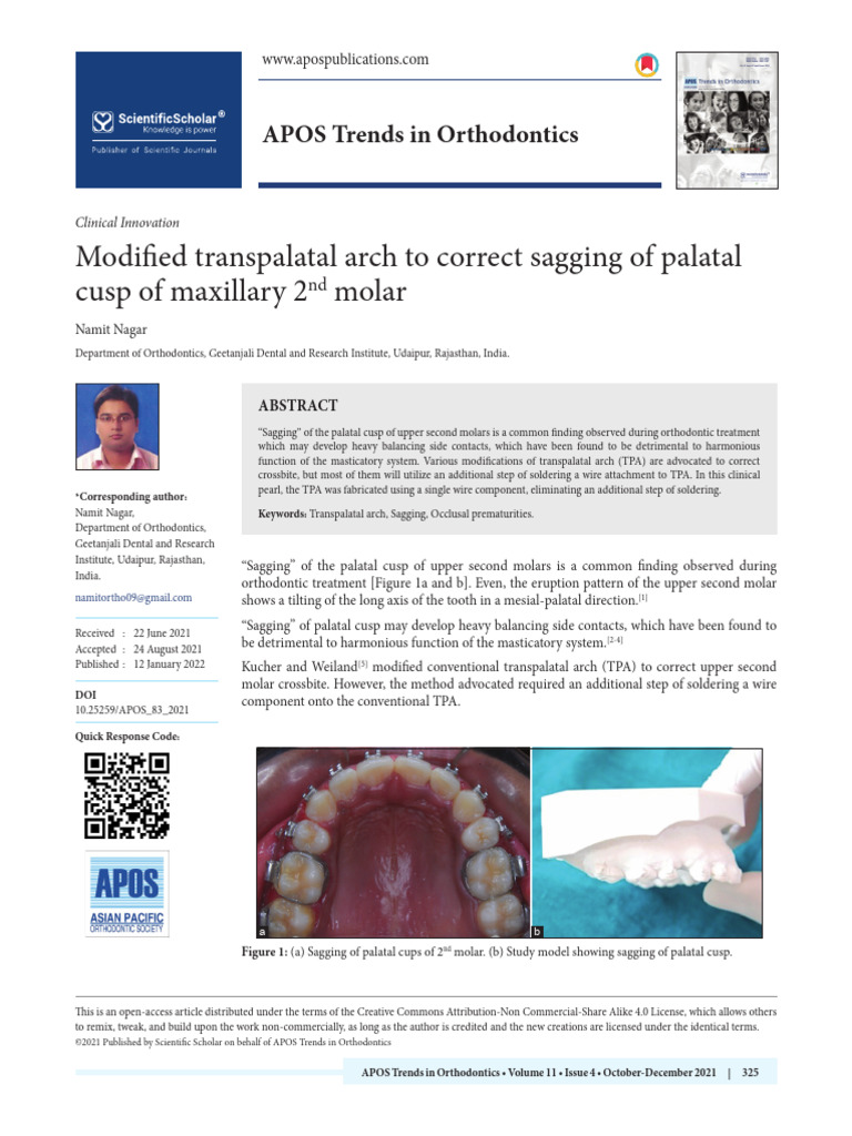 Modified Transpalatal Arch To Correct Sagging of Palatal | PDF ...