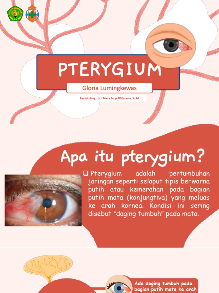 Pterygium: Gejala, Penyebab, dan Pencegahan | PDF