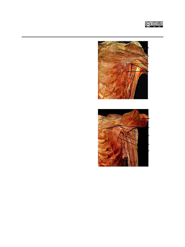 Pectoralis+Major+Flap 1 | PDF | Human Anatomy | Musculoskeletal System