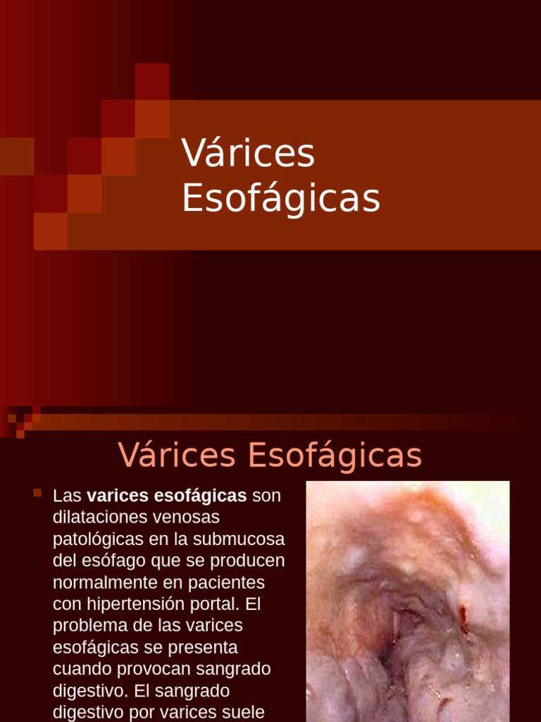 Várices Esofagicas | PDF | Especialidades Medicas | Medicina CLINICA