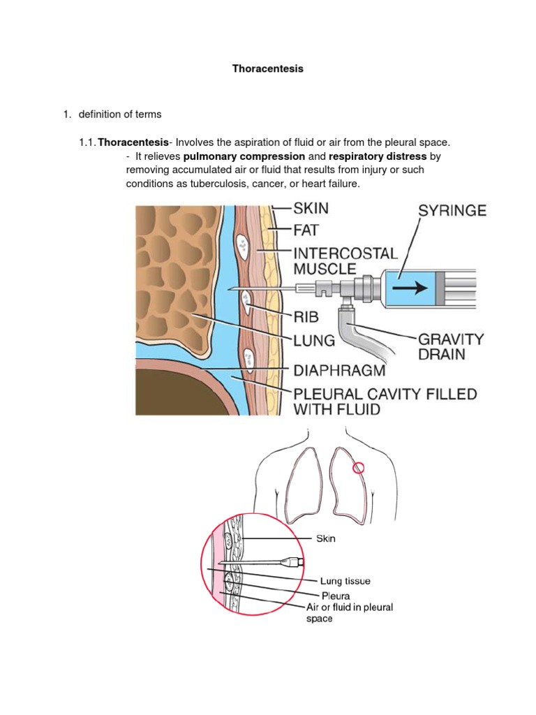 Thoracentesis | Lung | Respiratory System