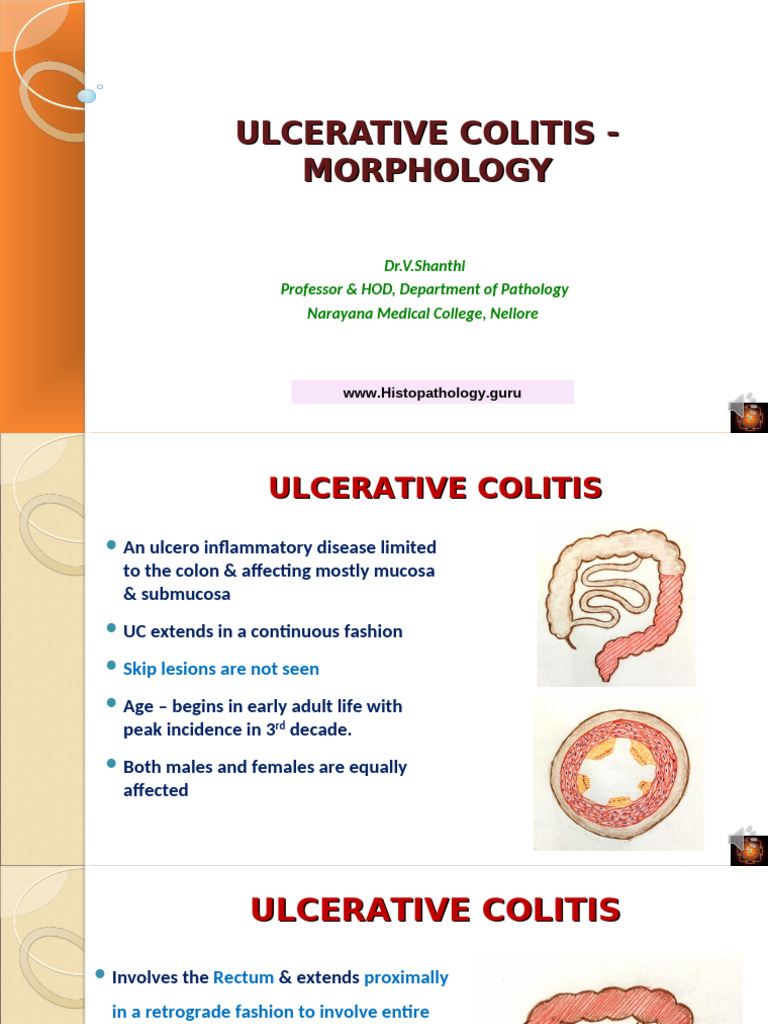 Ulcerative Colitis 1 | PDF | Ulcerative Colitis | Immunology