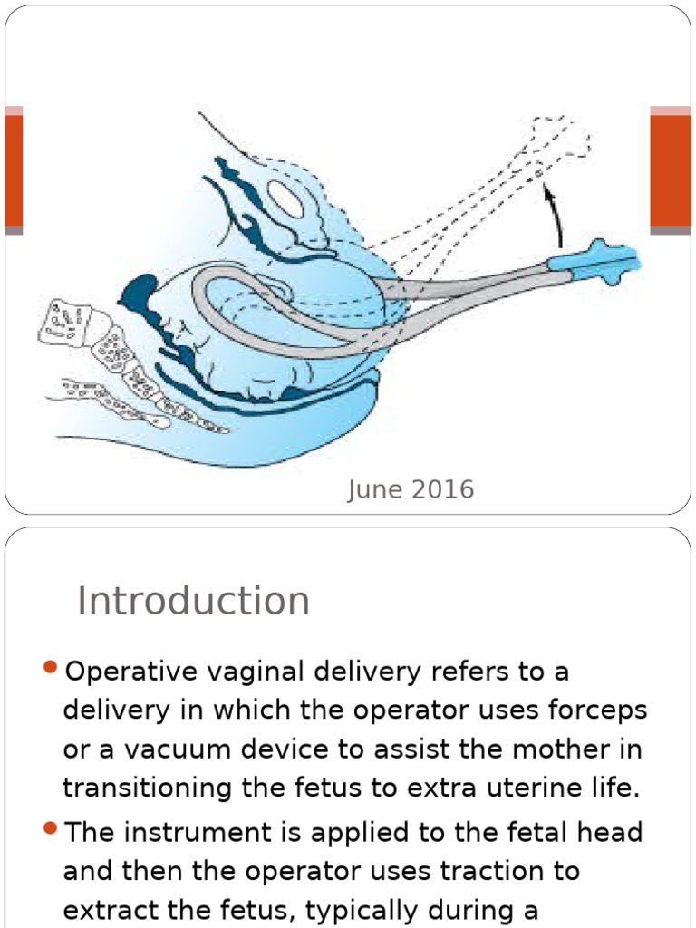 Instrumental Delivery Techniques Overview | PDF | Childbirth | Medical ...