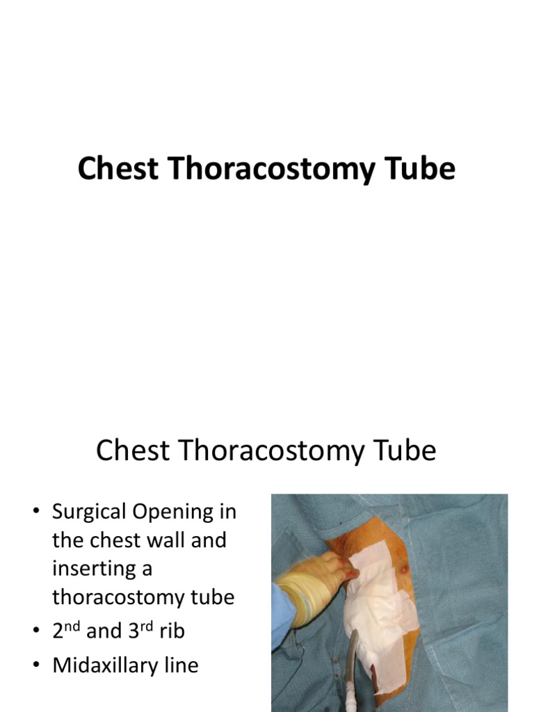 Chest Thoracostomy Tube | PDF