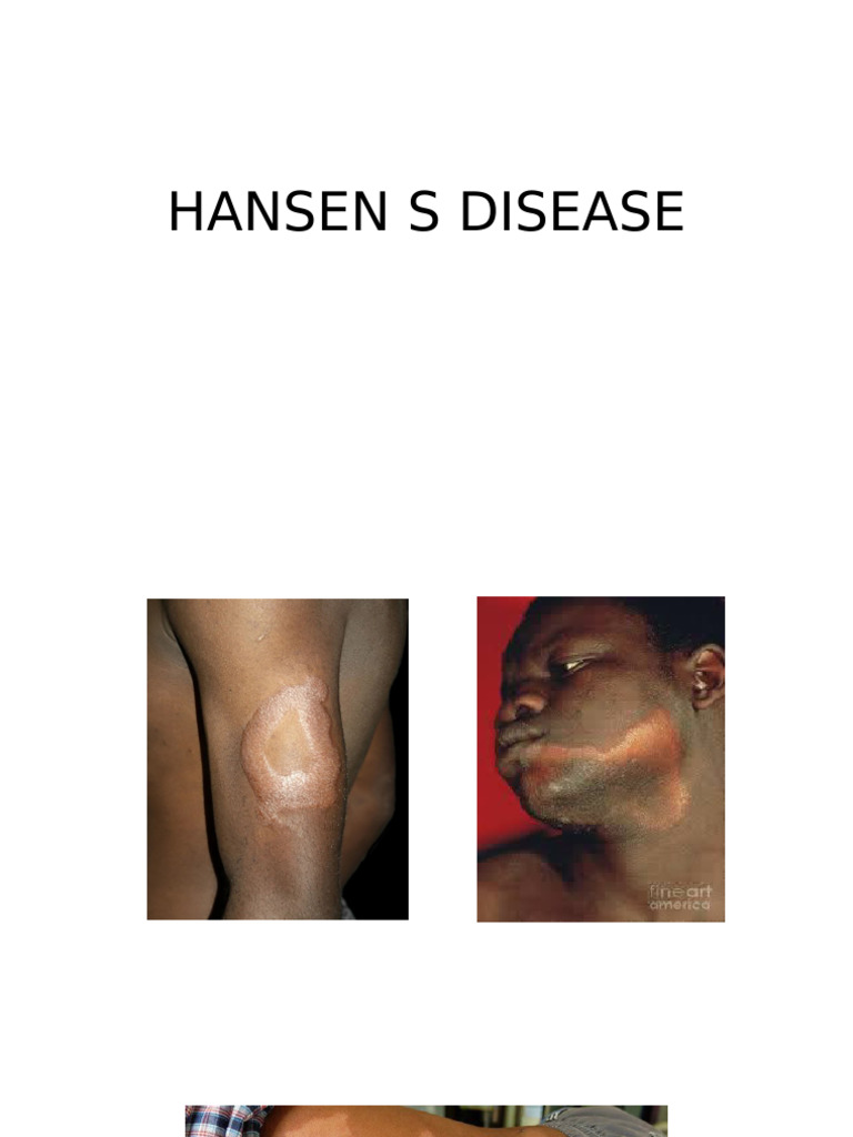 Hansen S Disease | PDF