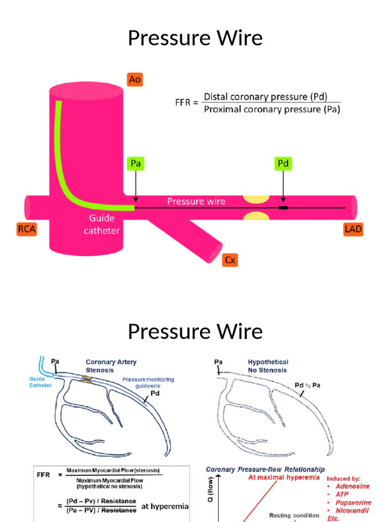 Pressure Wire | PDF