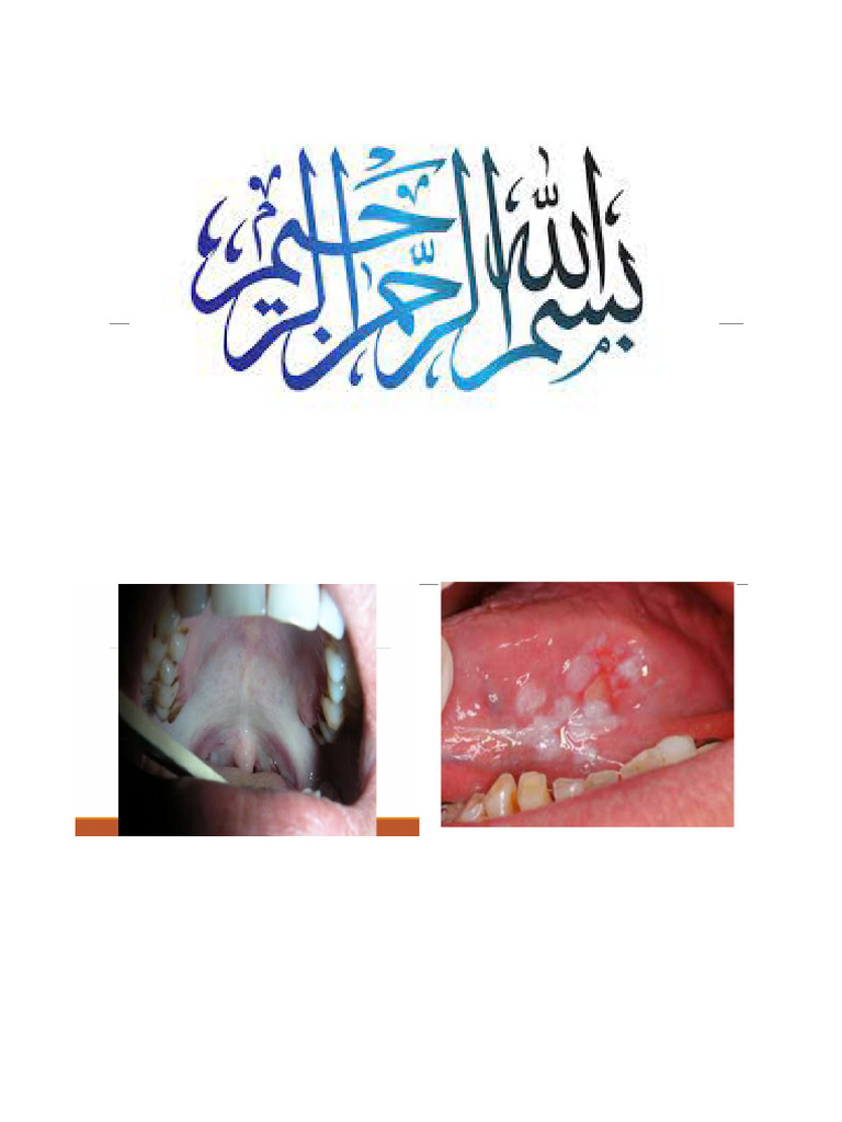 Open GIT 1. 4th Year MBBS GIT Module Lec 1 2precancerous and White Lesions of or 3j50cFm | PDF ...