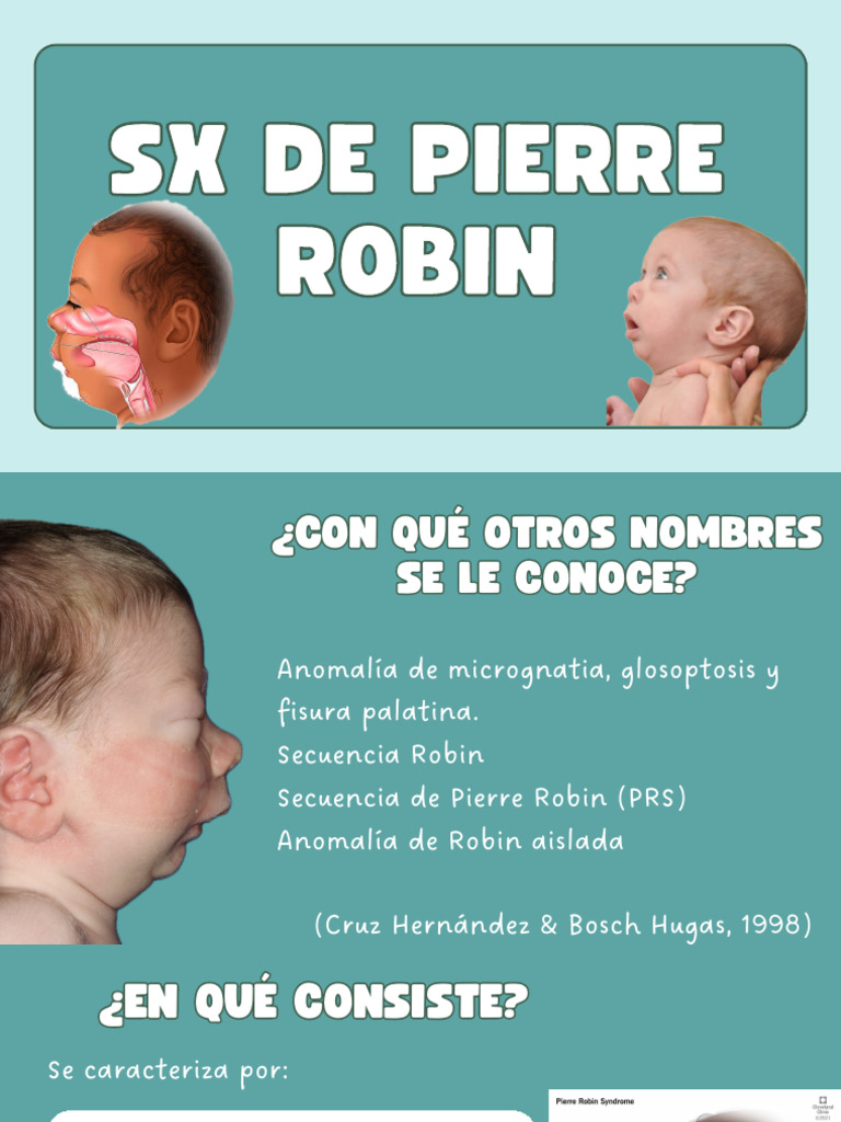 Secuencia Pierre Robin | PDF