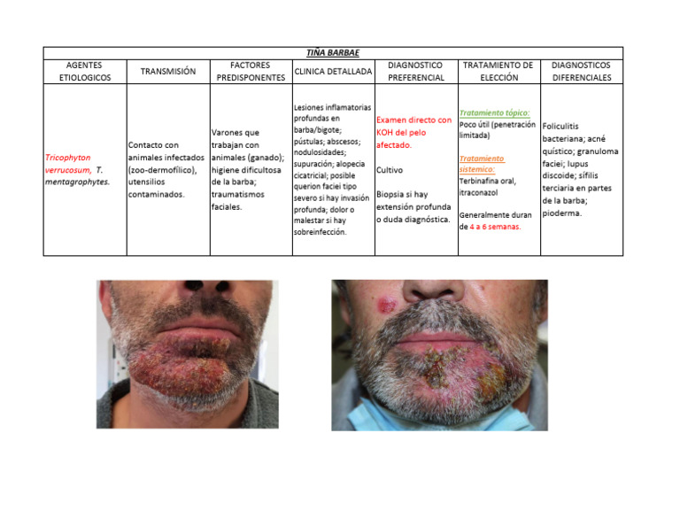 Tiña Barbae | PDF | Enfermedades y trastornos | Especialidades Medicas