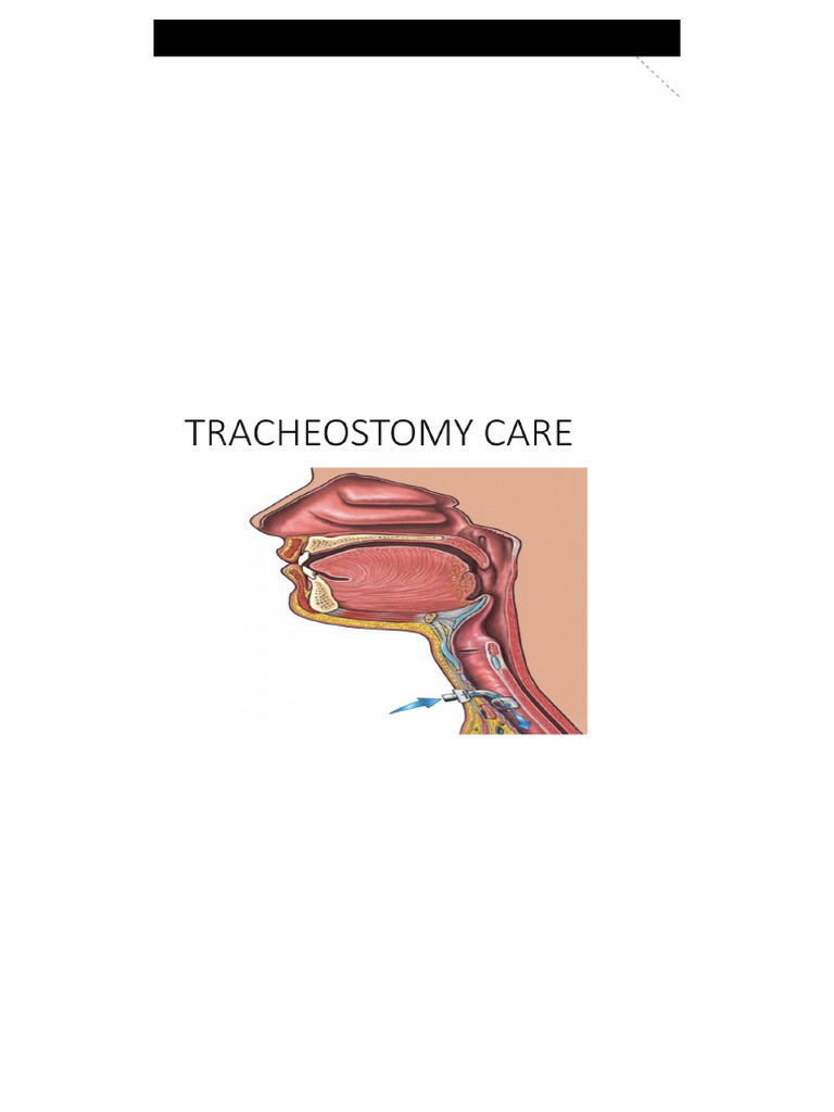 Tracheostomy Care | PDF