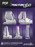 Arthrex Ankle Fracture Management System | PDF | Screw | Drill