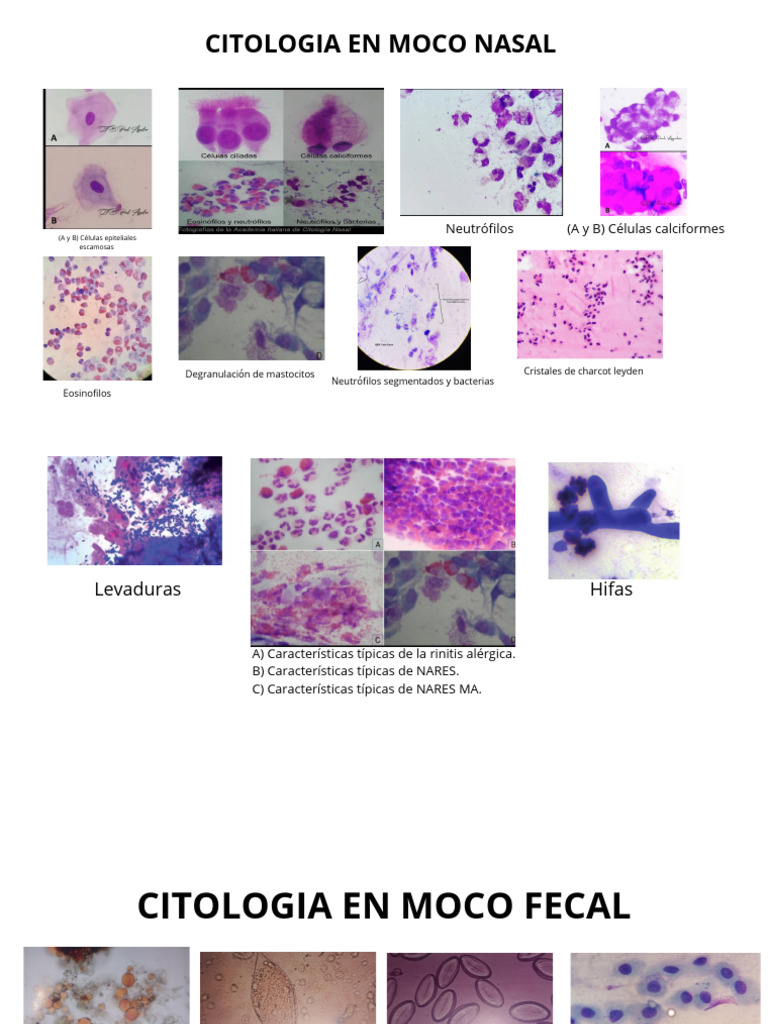 Mastocitos en moco nasal | PDF