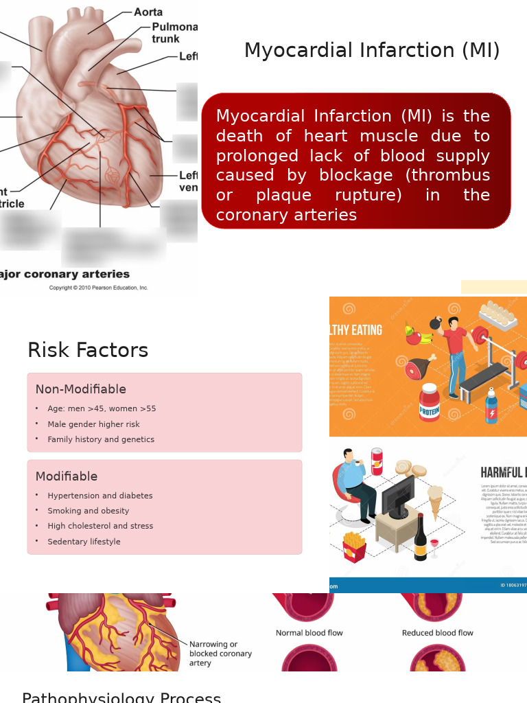 Myocardial Infarction MI | PDF | Myocardial Infarction | Percutaneous ...