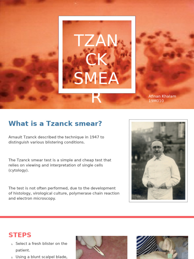Tzanck Smear: Procedure and Insights | PDF