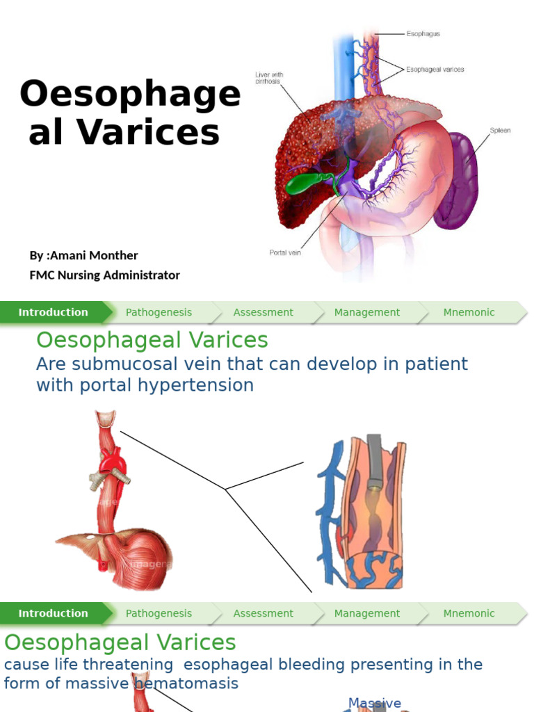 Oesophageal Varices PPT Updated | PDF | Esophagus | Vein