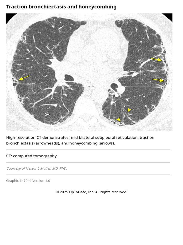 Traction Bronchiectasis and Honeycombing | PDF