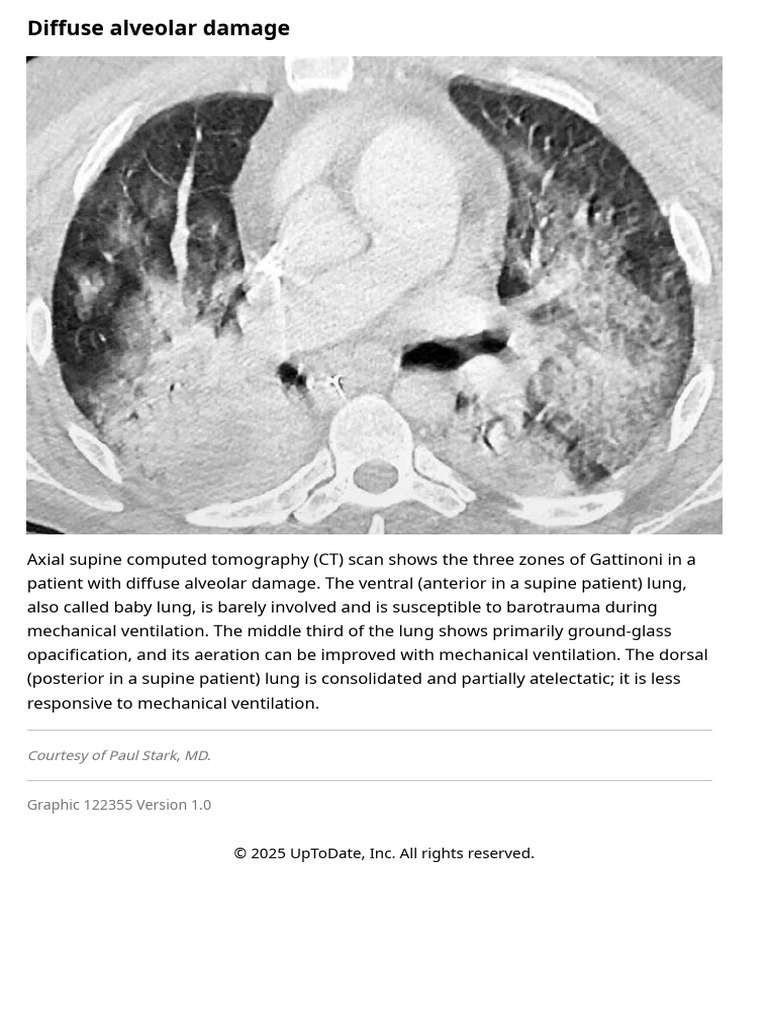 Diffuse Alveolar Damage II | PDF