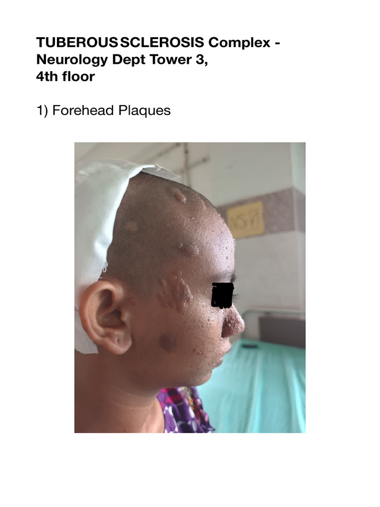Tuberous Sclerosis Complex | PDF