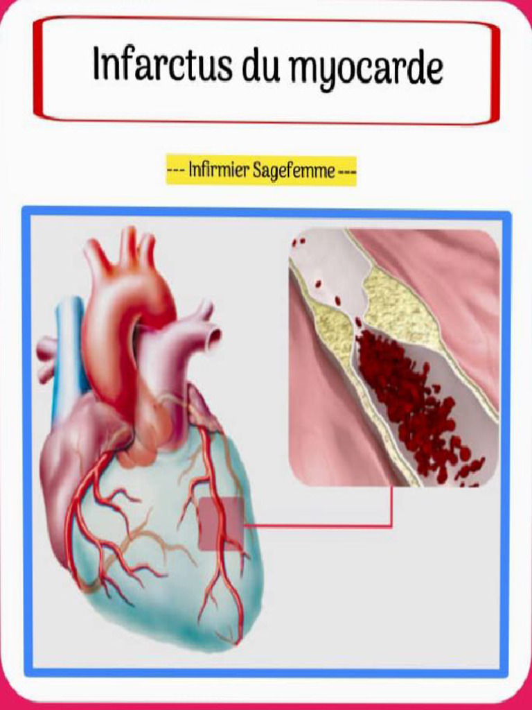Infarctus Du Myocarde | PDF