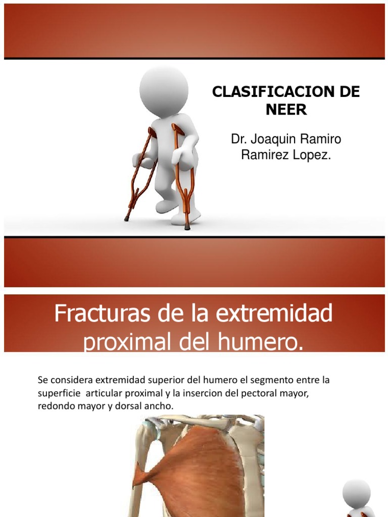 Fracturas Proximales de Húmero: Clasificación Neer | PDF | Hombro ...