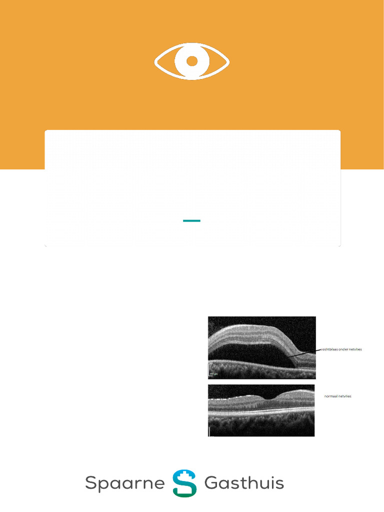 Retinitis Centralis Serosa | PDF