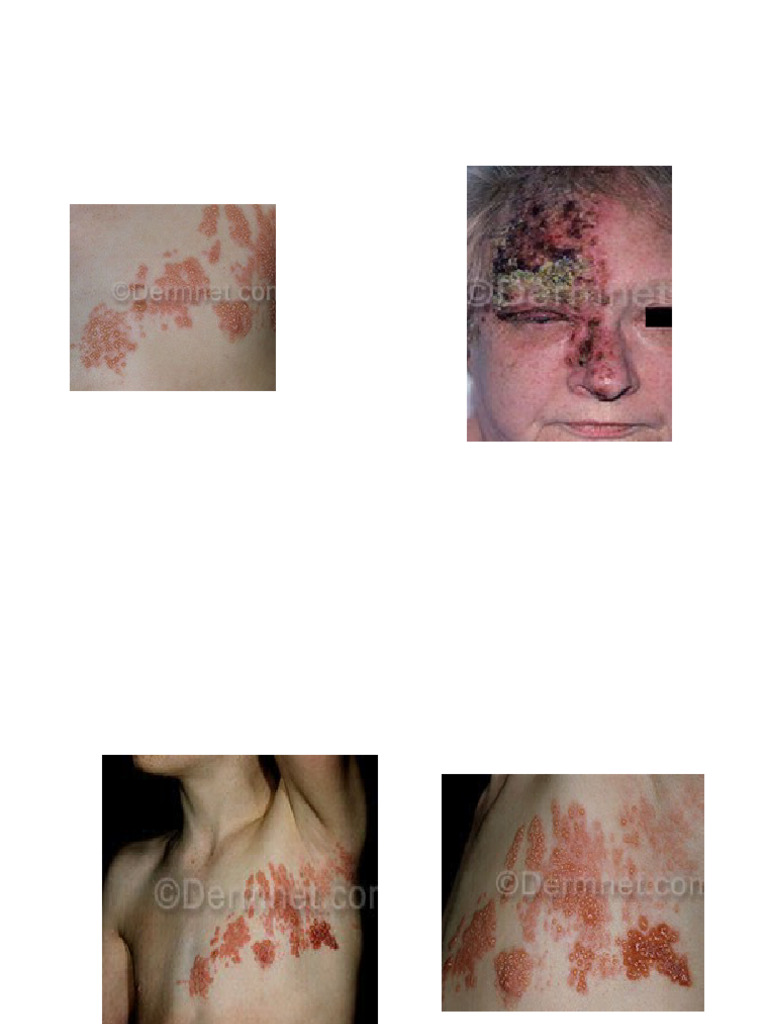 Herpes Zoster Progression Explained | PDF
