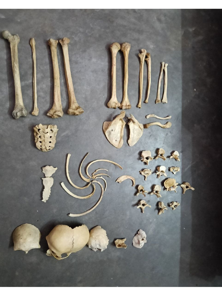 Bilateral Boneset | PDF