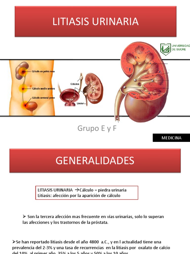 litiasis urinaria | Calcio | Sistema urinario