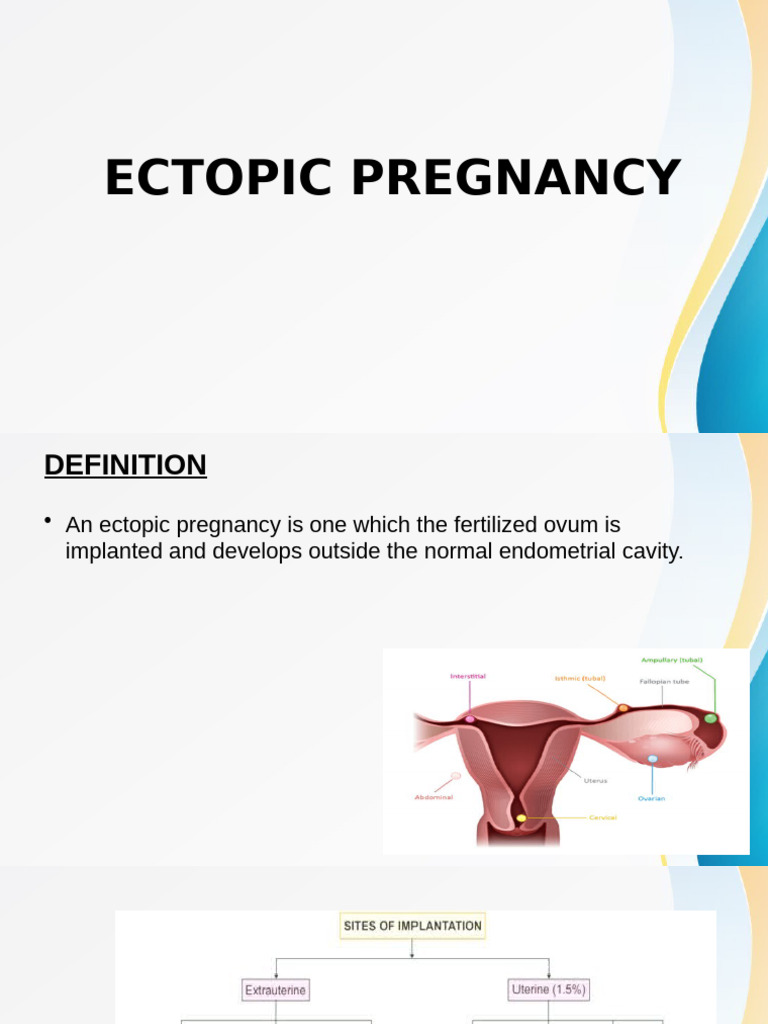 2.ectopic Pregnancy | PDF | Women's Health | Human Reproduction