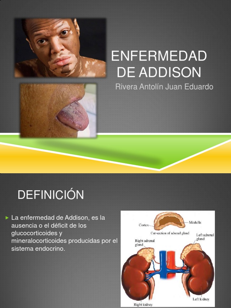 Enfermedad de Addison | Descargar gratis PDF | Glándula suprarrenal ...