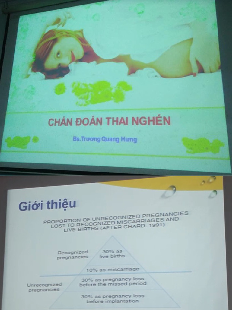 1.1. [y4-San-s-y16-2020] Dx Thai Nghén (Hưng) | PDF
