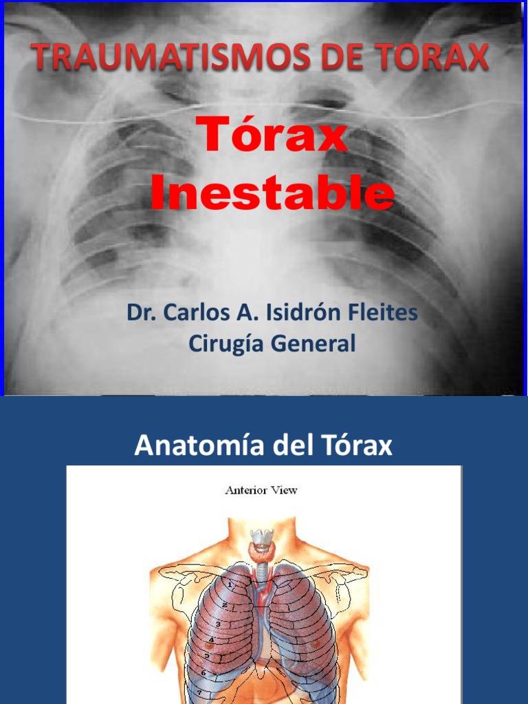 Tratamiento del Tórax Inestable | PDF | Lesión | Tórax