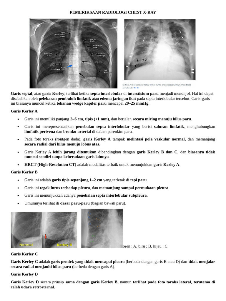 Pemahaman Garis Kerley pada X-Ray Paru | PDF