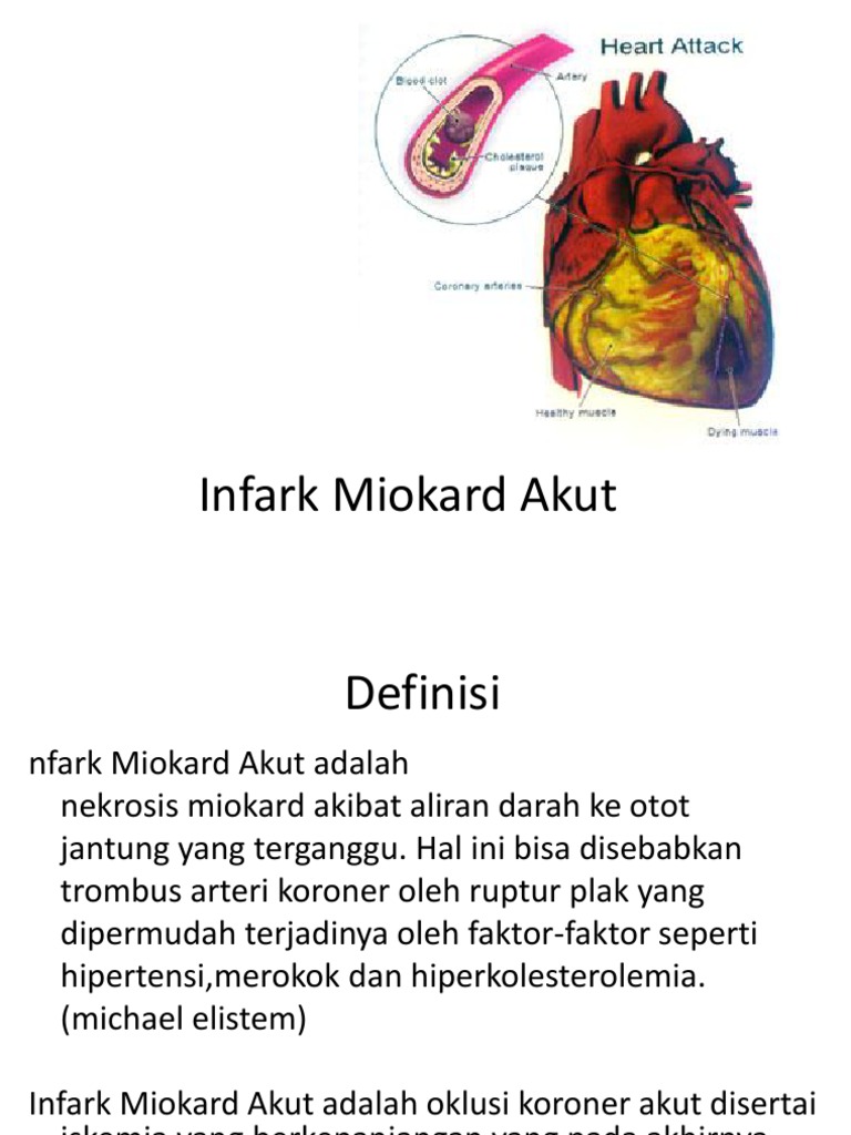 Infark Miokard Akut | PDF