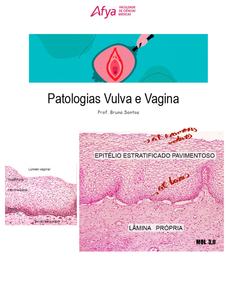 Patologias Vulva e Vagina - pptx-2 | PDF | Neoplasmas | Candidíase